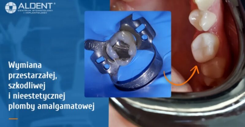 Bezpieczne usunięcie amalgamatu. - Aldent